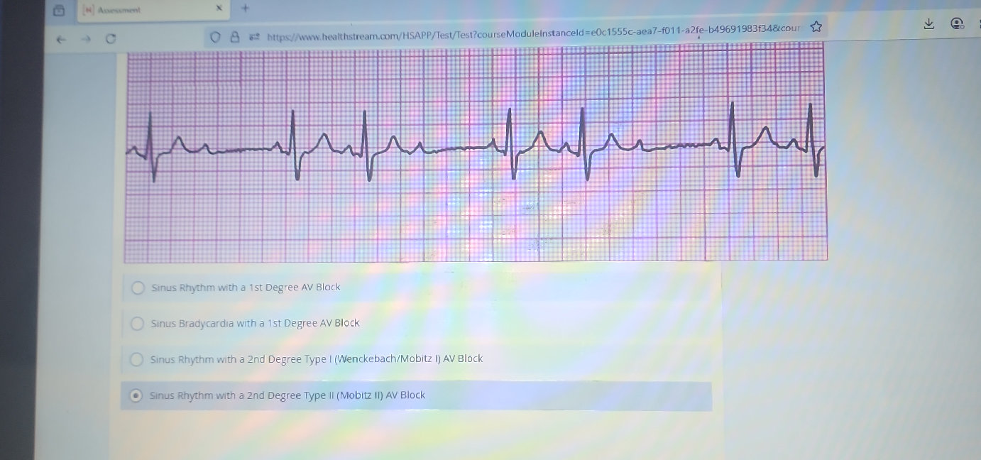 Identify the rhythm shown in the ECG strip. | StudyX