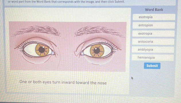 One or both eyes turn inward toward the nose | StudyX