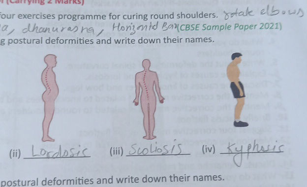 Identify the following postural deformities | StudyX