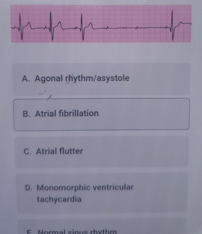 Image of ECG waveform A Agonal | StudyX
