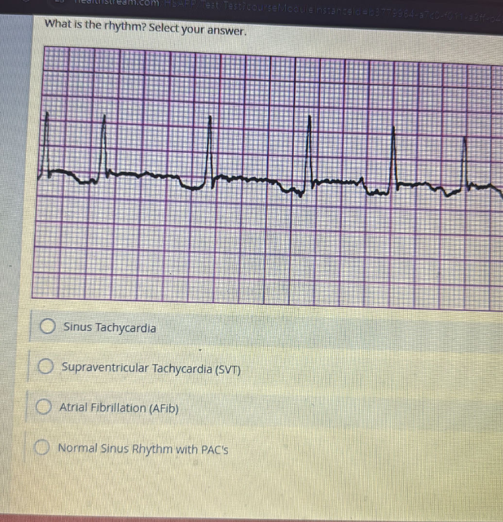 What is the rhythm? Select your answer. | StudyX