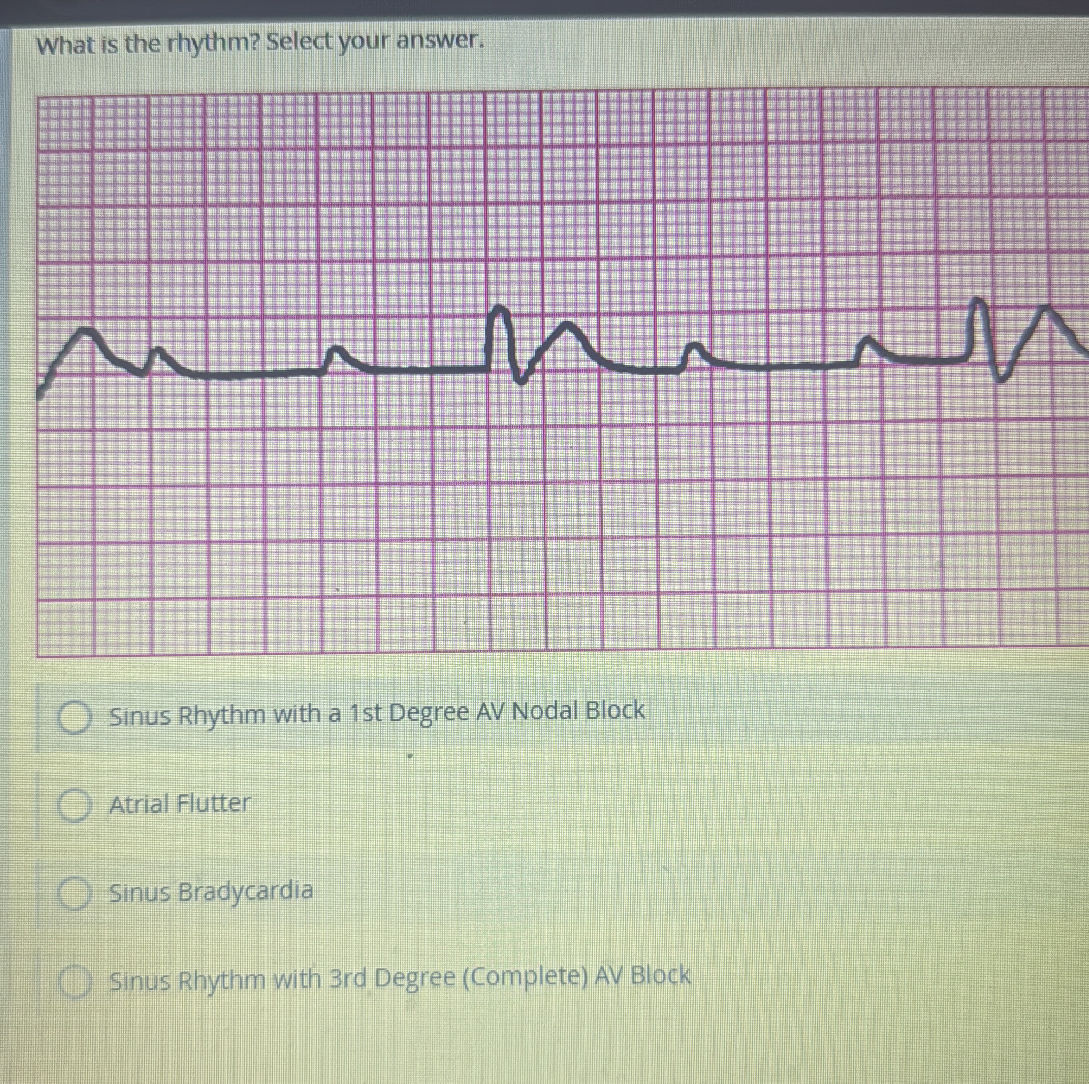 What is the rhythm? Select your answer. | StudyX