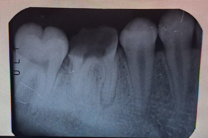 Analyze the provided periapical radiograph | StudyX
