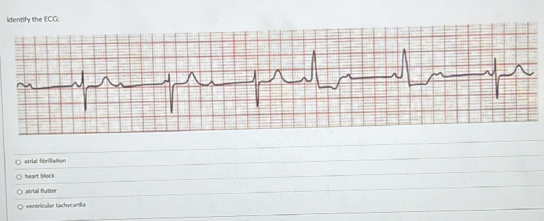 Identify the ECG: [Image of an ECG strip | StudyX