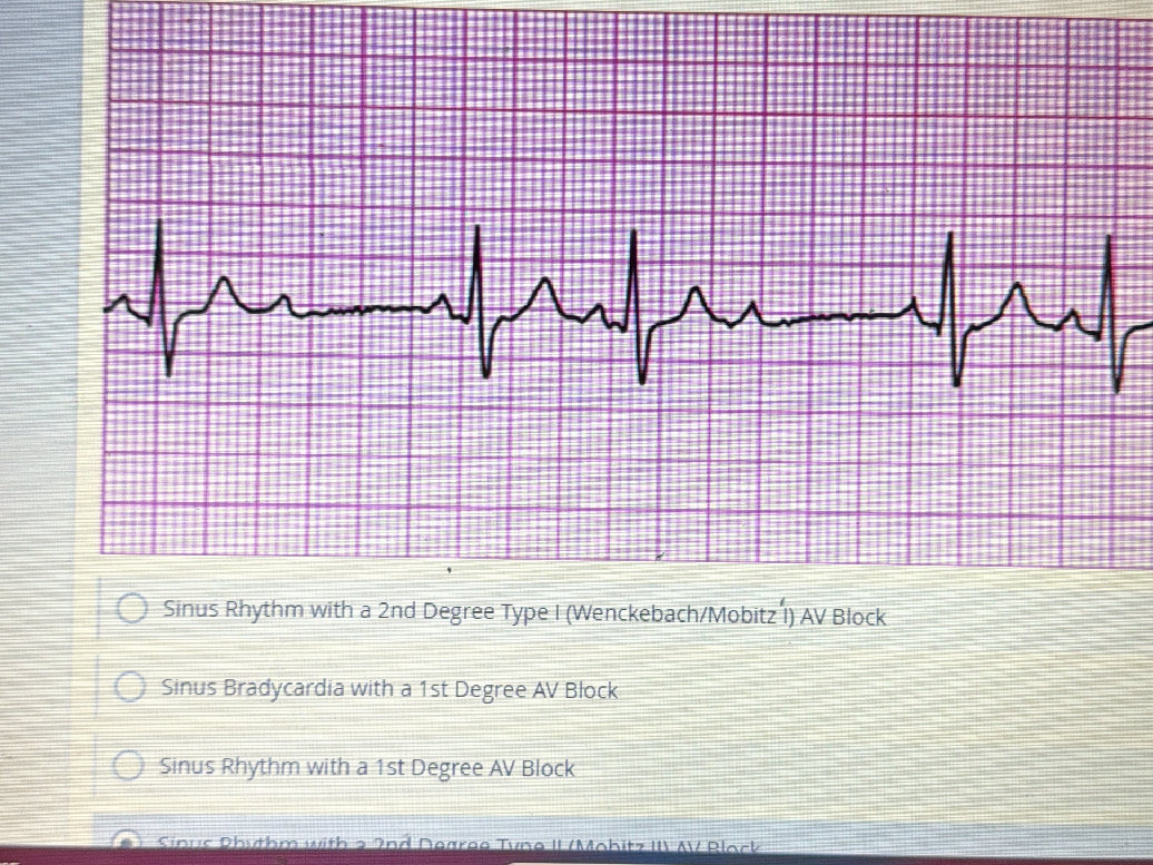 Identify the cardiac rhythm shown in the | StudyX