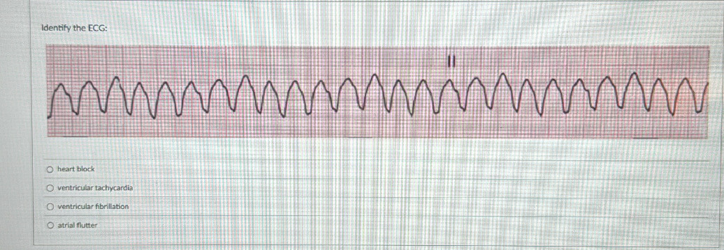 Identify the ECG: [ECG Tracing] heart | StudyX