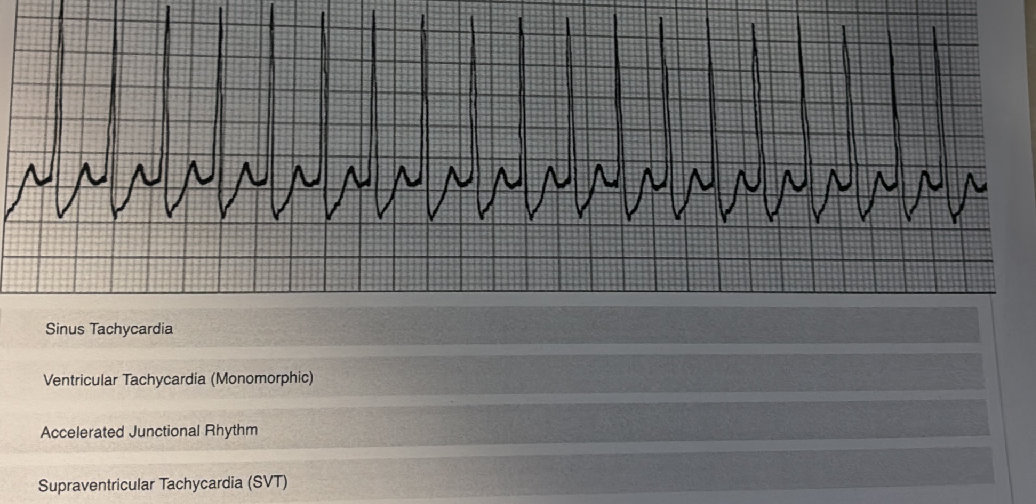 Identify the cardiac rhythm shown in the | StudyX