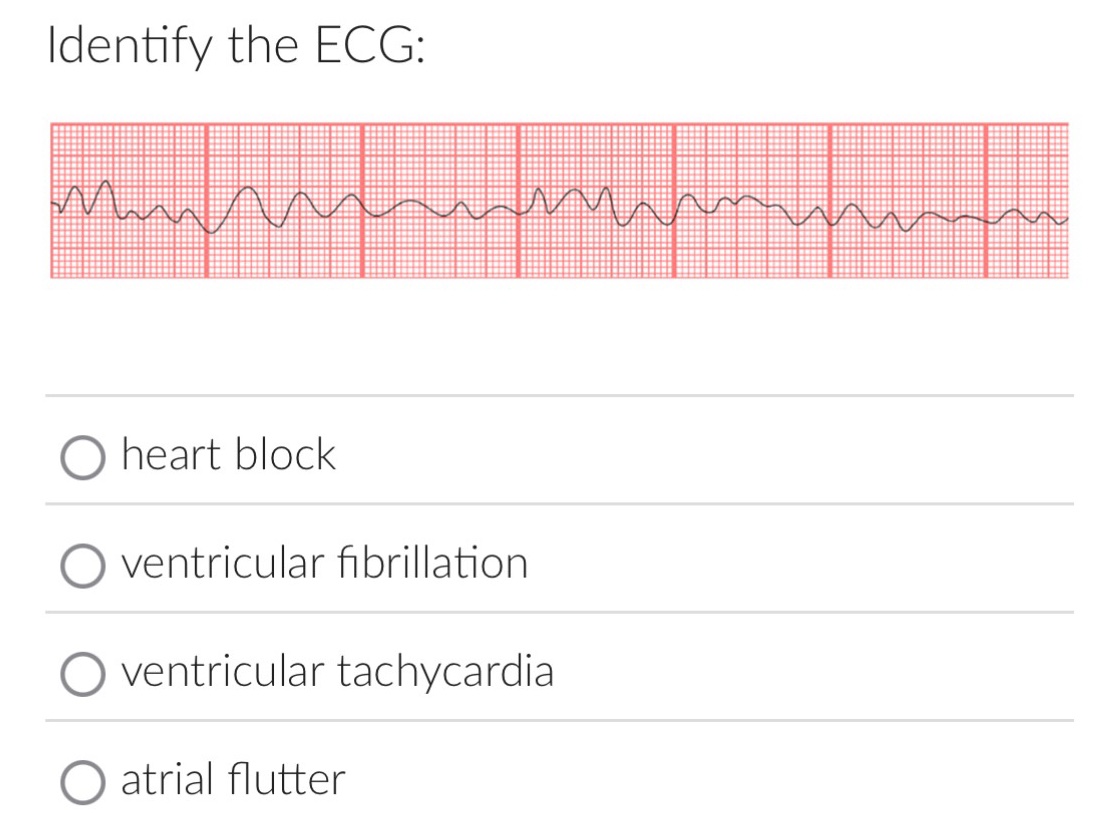 Identify the ECG: heart block ventricular | StudyX