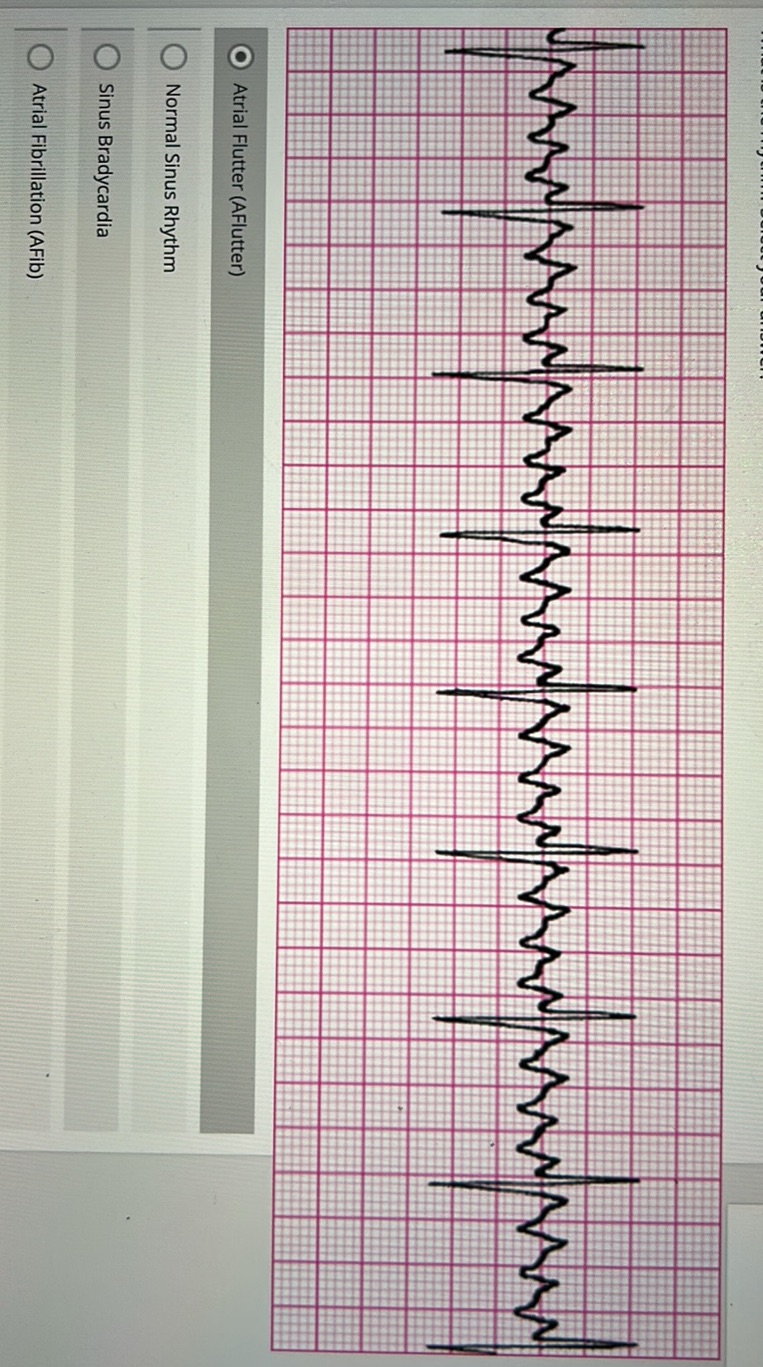 Atrial Flutter (AFlutter) Normal Sinus | StudyX