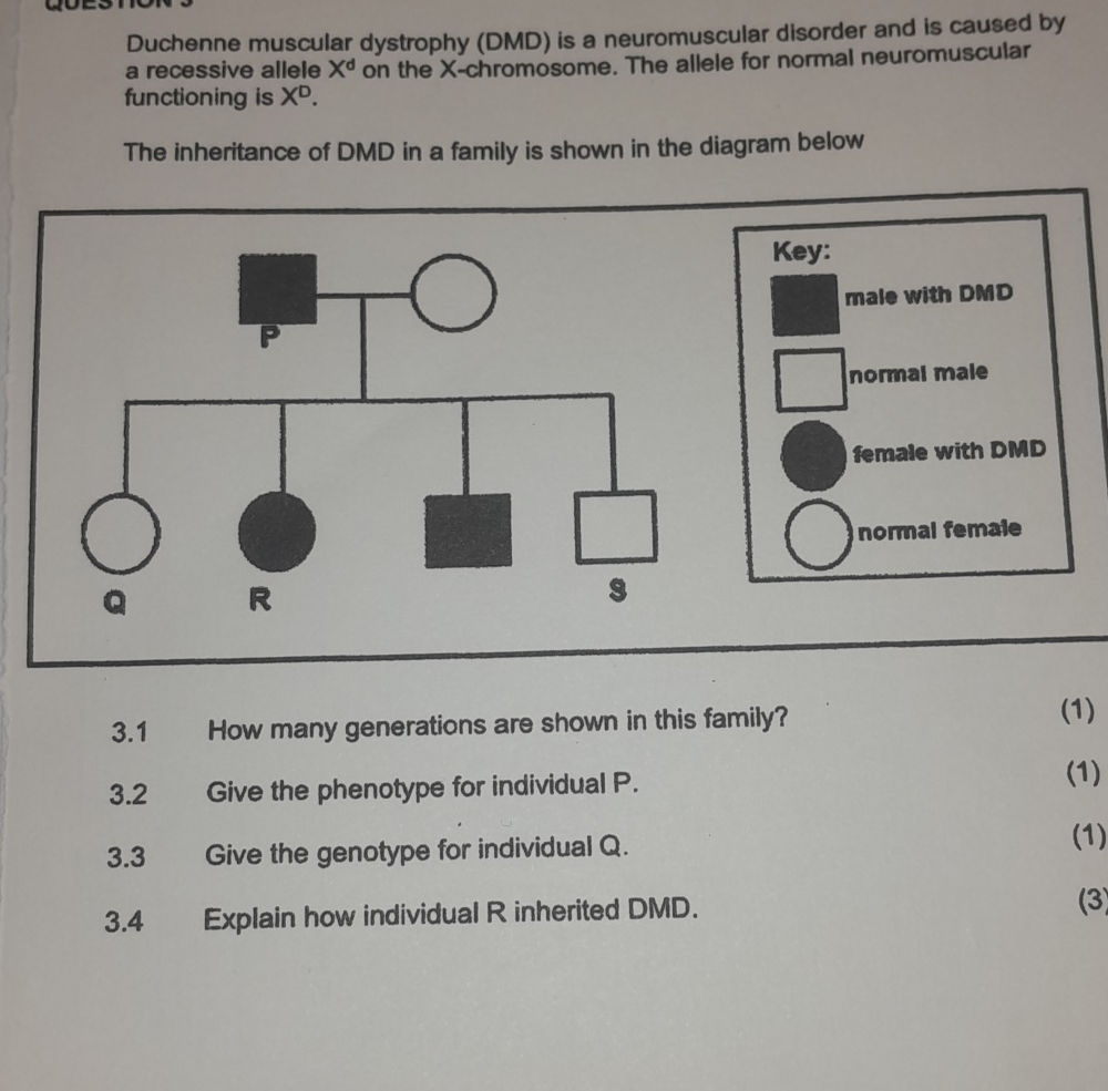 Duchenne muscular dystrophy (DMD) is a | StudyX
