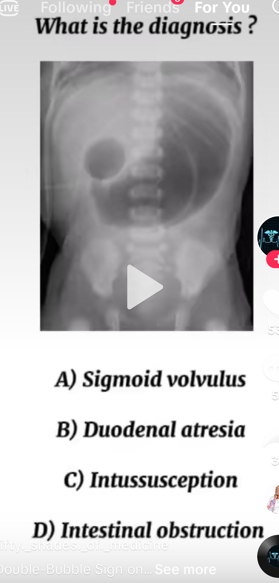 What is the diagnosis ? A) Sigmoid volvulus | StudyX