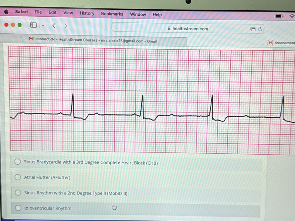 Sinus Bradycardia with a 3rd Degree Complete | StudyX