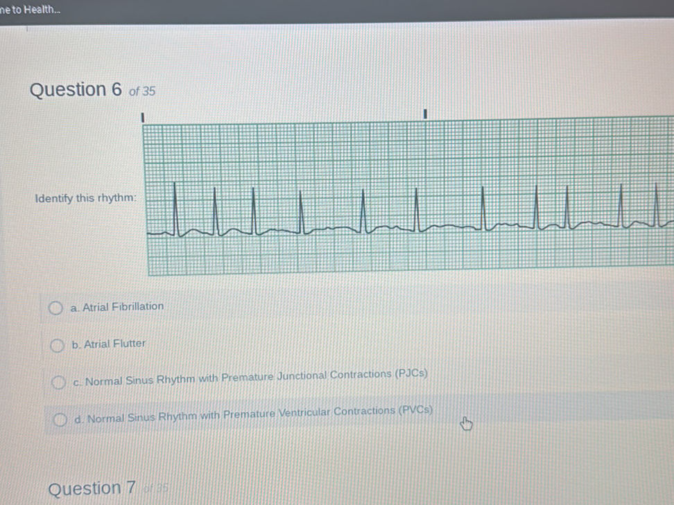 Identify this rhythm: a. Atrial Fibrillation | StudyX