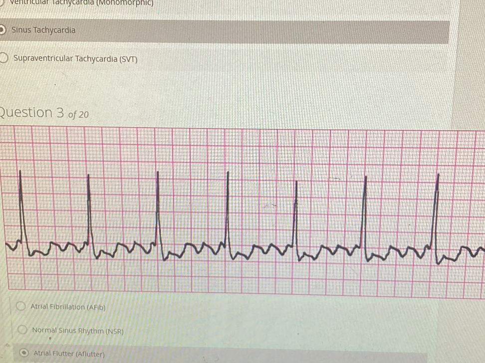 Sinus Tachycardia Supraventricular | StudyX
