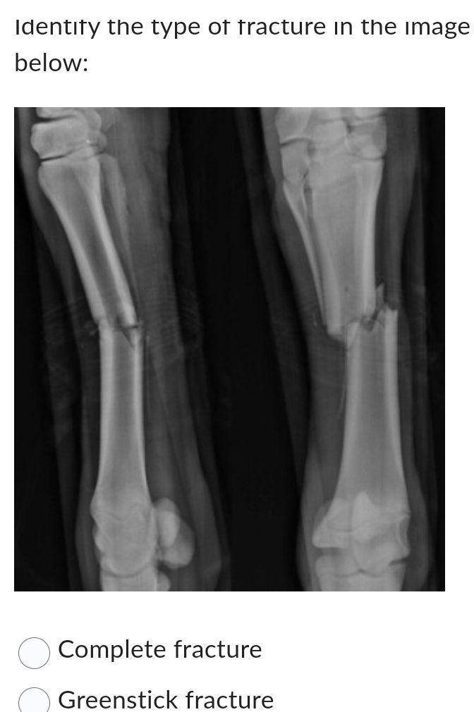 Identify the type of fracture in the image | StudyX