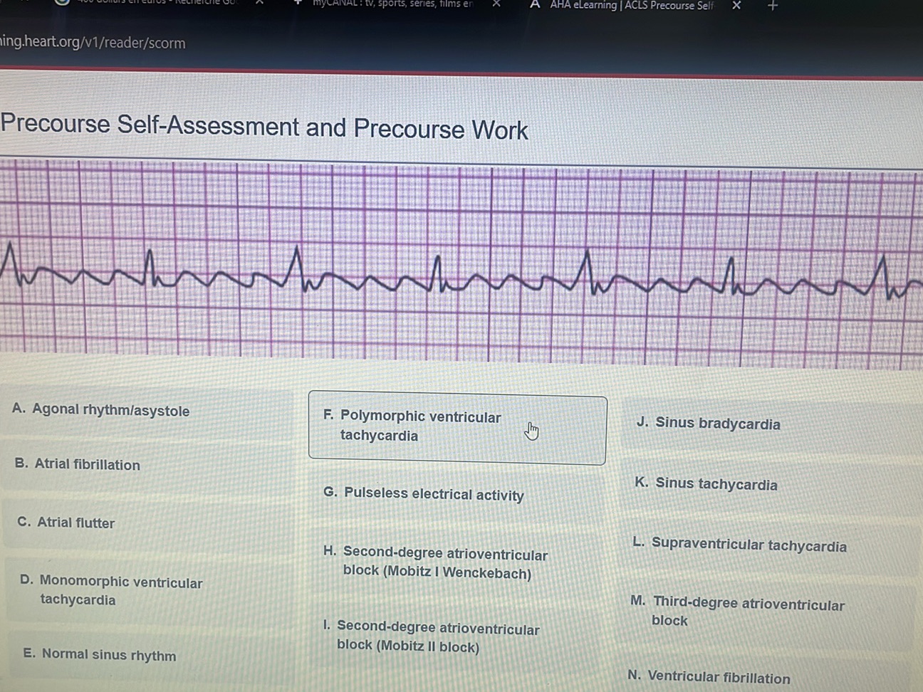 Based on the provided ECG, identify the | StudyX