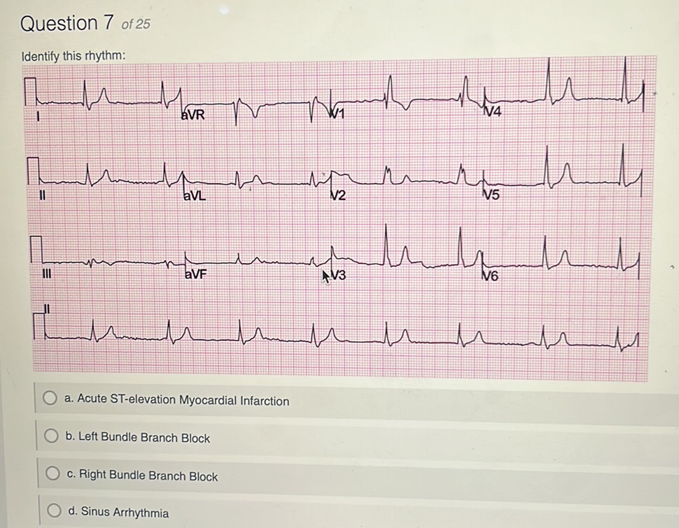 Identify this rhythm: a. Acute ST-elevation | StudyX
