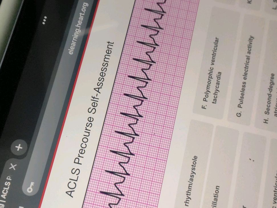 Based on the ECG strip, what is the most | StudyX