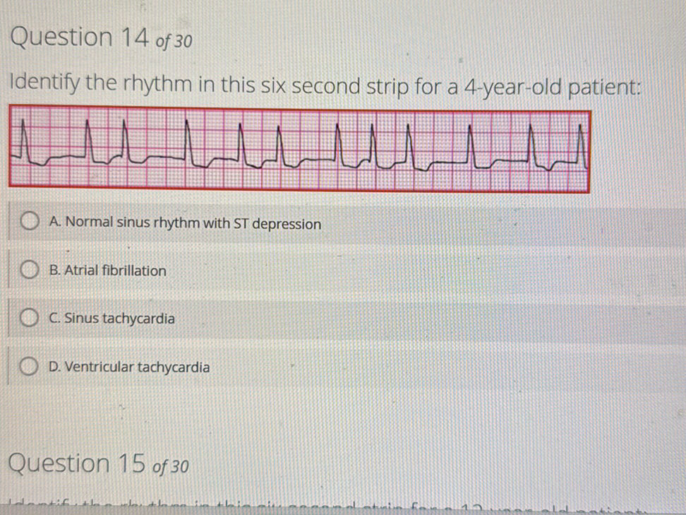 Identify the rhythm in this six second strip | StudyX