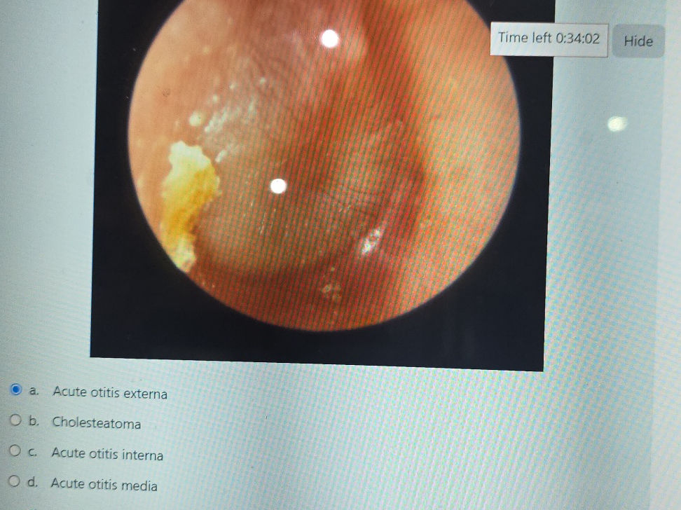 a. Acute otitis externa b. Cholesteatoma | StudyX