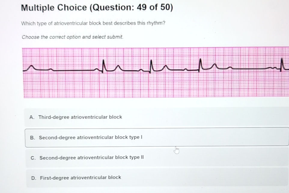 Which type of atrioventricular block best | StudyX