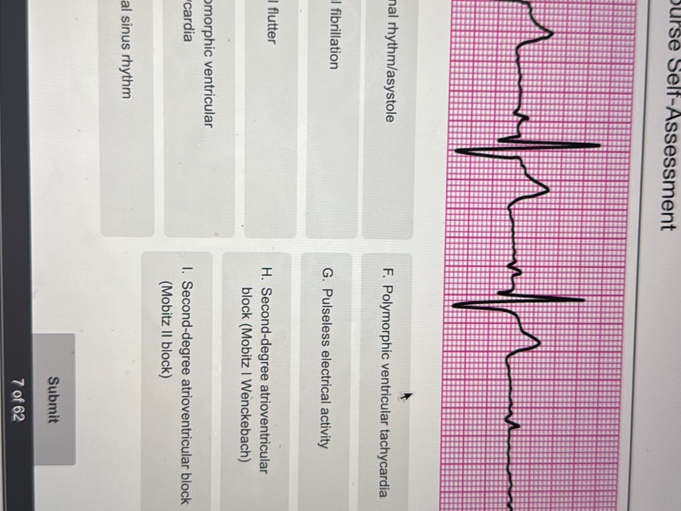 Match the ECG rhythm to the following | StudyX