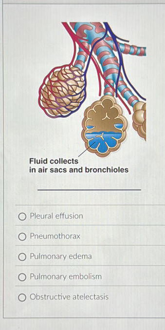 Fluid collects in air sacs and bronchioles | StudyX
