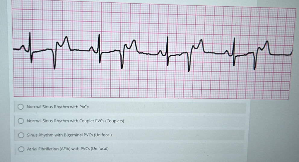 Normal Sinus Rhythm with PACs Normal Sinus | StudyX