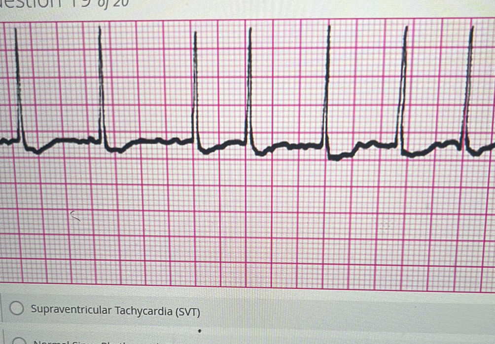 Supraventricular Tachycardia (SVT) Normal | StudyX