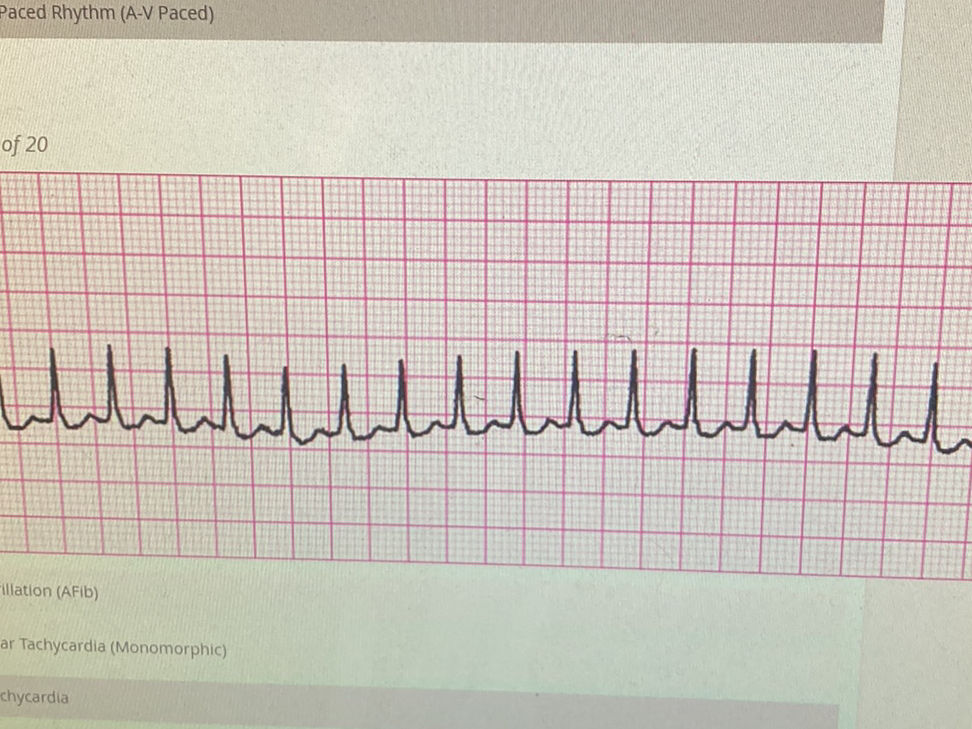 The image shows an ECG rhythm strip. The | StudyX