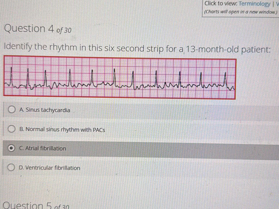 Identify the rhythm in this six second strip | StudyX