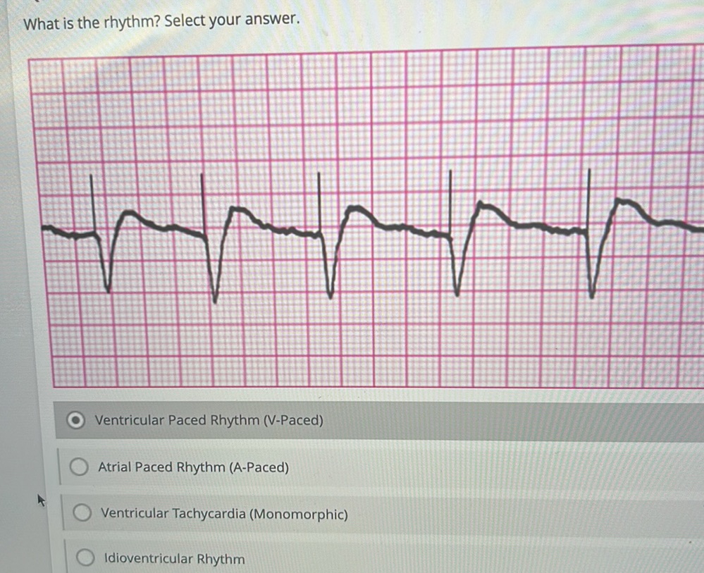 What is the rhythm? Select your answer.