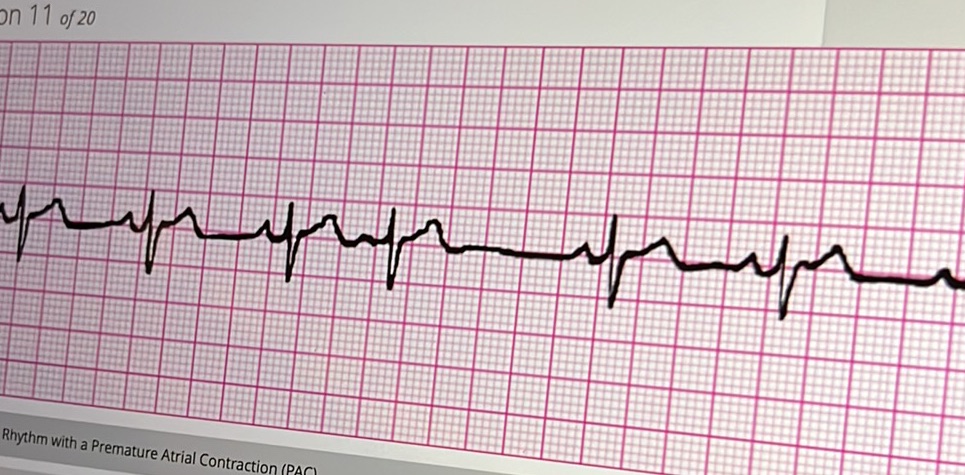 The image shows an ECG rhythm strip. The | StudyX