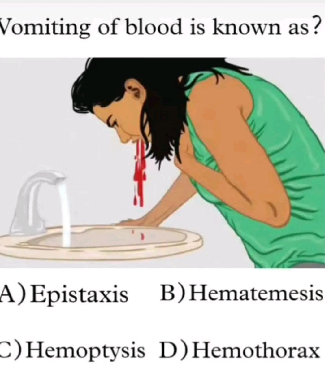 Vomiting of blood is known as? A) Epistaxis | StudyX