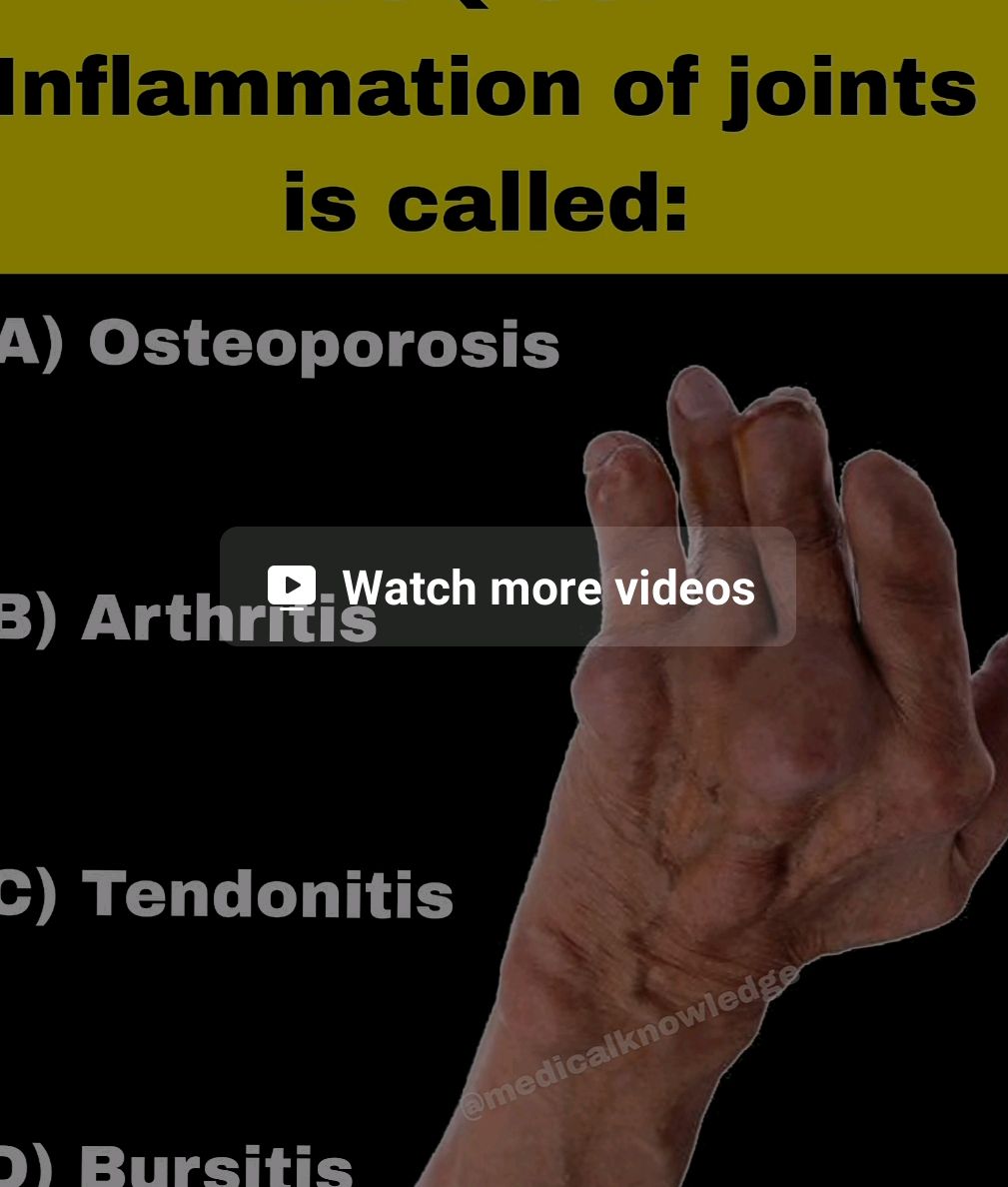 Inflammation of joints is called: A)
