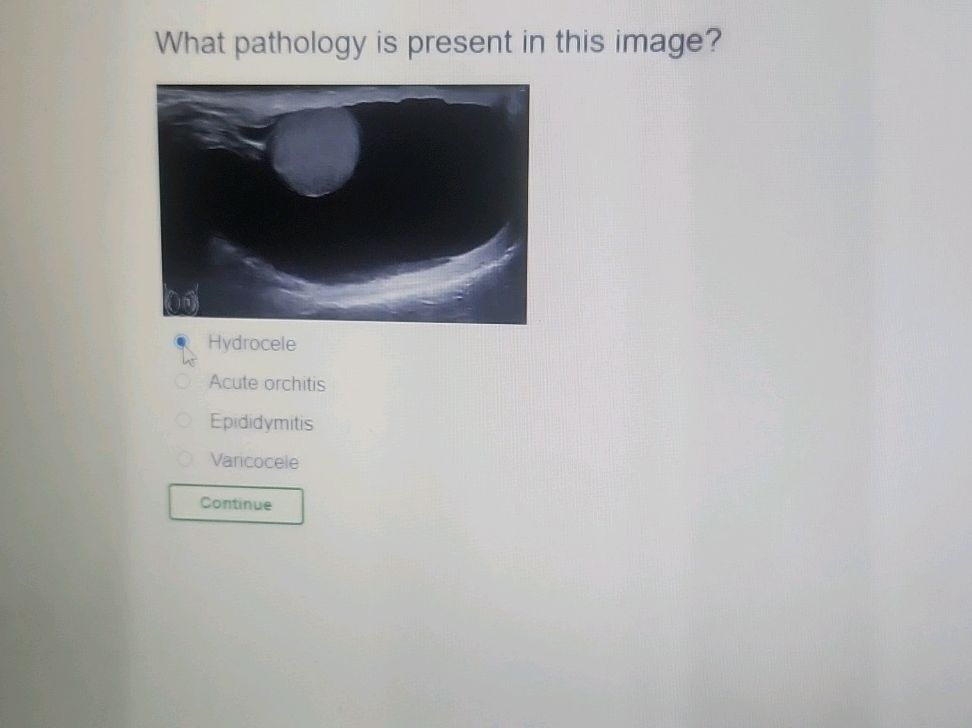 What pathology is present in this image? | StudyX