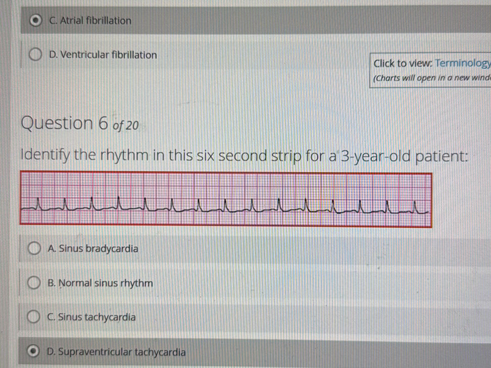 Identify the rhythm in this six second strip | StudyX