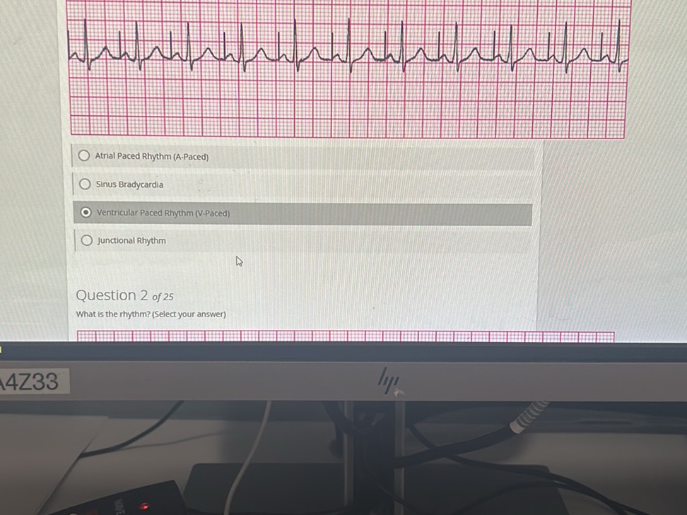 Atrial Paced Rhythm (A-Paced) Sinus | StudyX