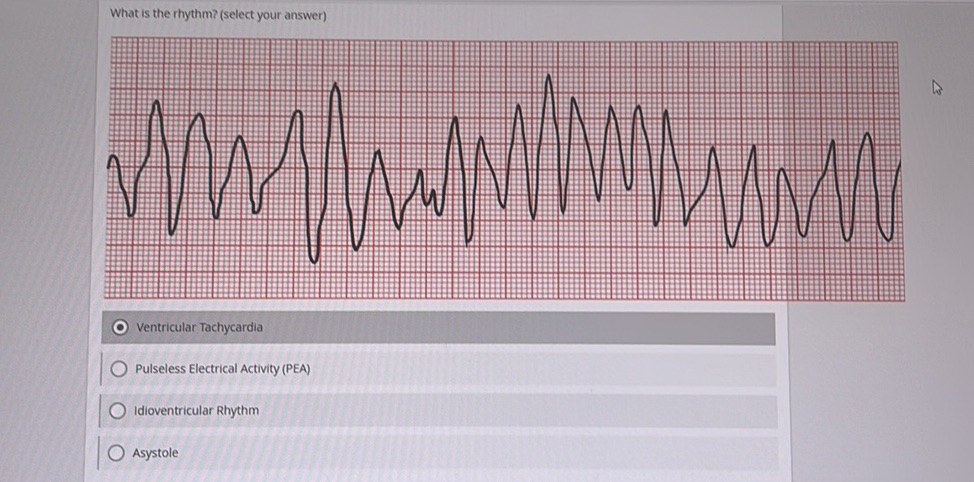 What is the rhythm? (select your answer) | StudyX
