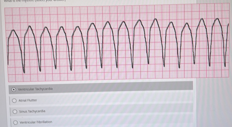 What is the rhythm? (select your answer) * | StudyX