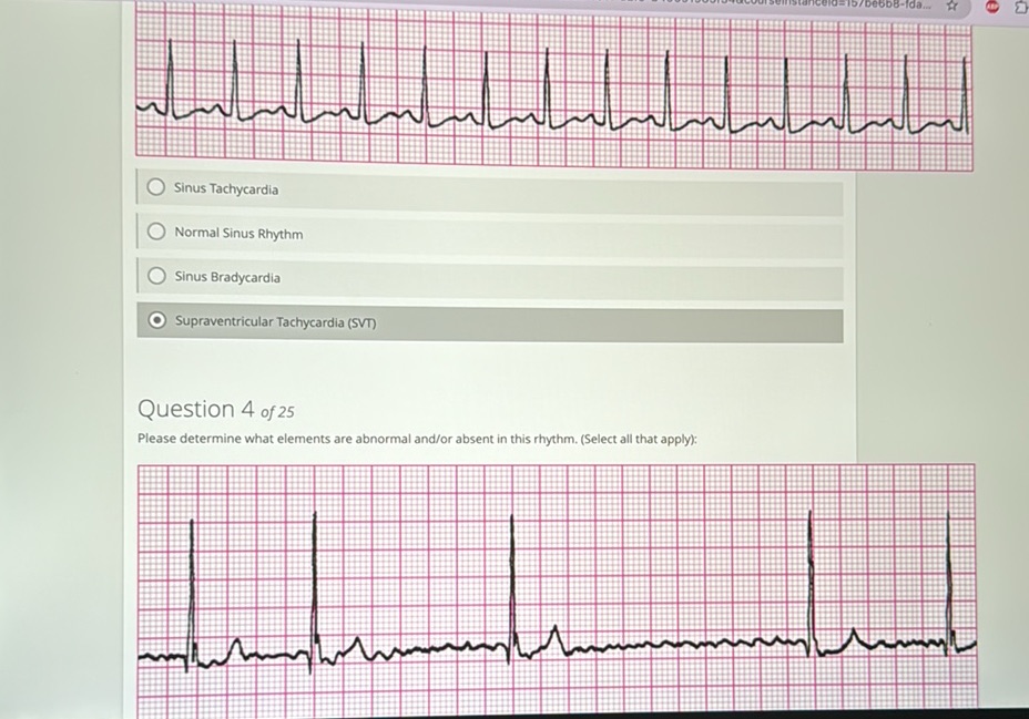 Sinus Tachycardia Normal Sinus Rhythm Sinus | StudyX
